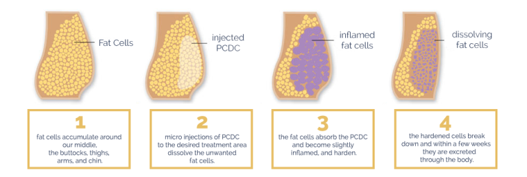 Fat Dissolve - Beyond Body Sculpting